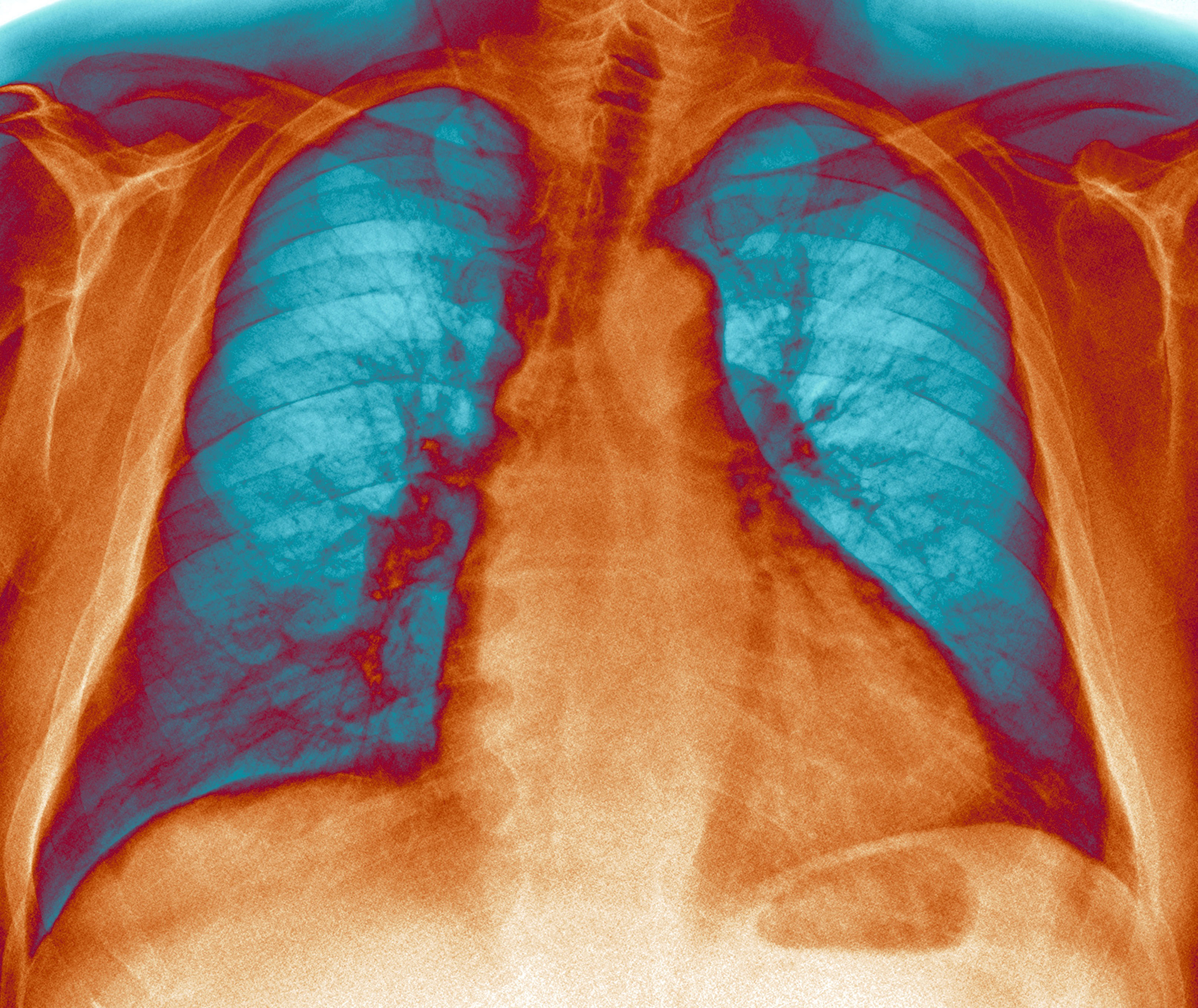 Researchers identify new drug target for serious heart and lung condition