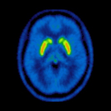 Dopamine Levels Offer Clue to Schizophrenia