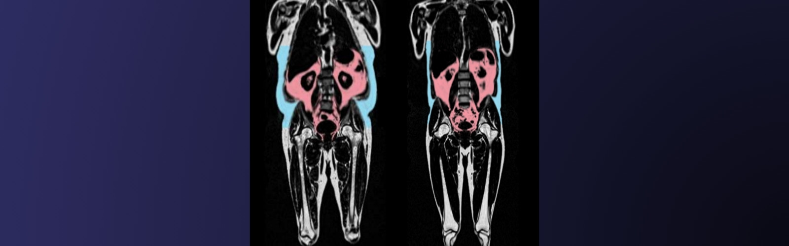 New study finds hidden body fat is linked to faster heart ageing