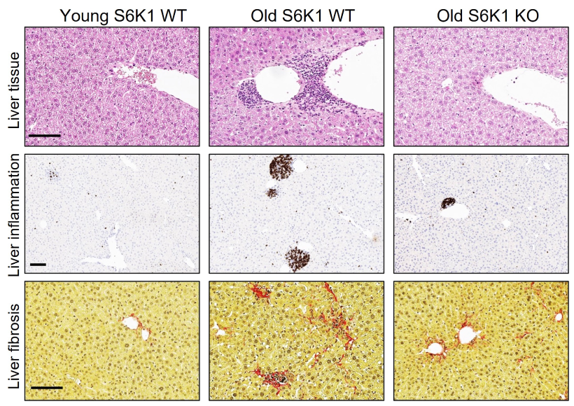 Blocking the longevity gene S6K1 extends lifespan by reducing inflammation