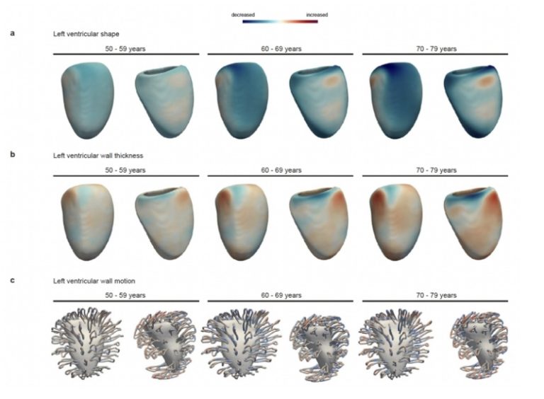 How old is your heart? AI predicts “heart age” and pinpoints link to genes.